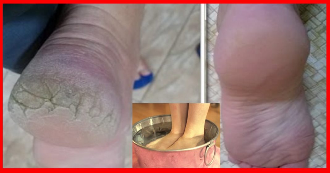 Rachadura no Calcanhar: Como Tirar com Remédio Caseiro – Sky Nerd