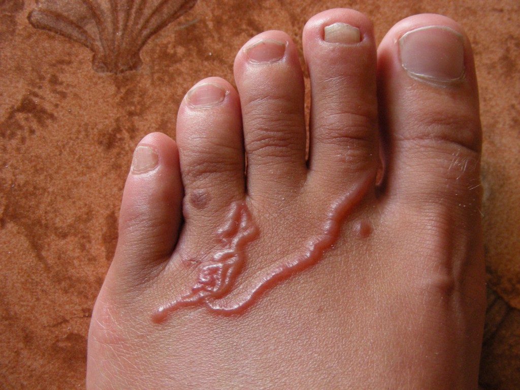 Bicho Geografico – Sintomas, Tratamento e Fotos – Sky Nerd